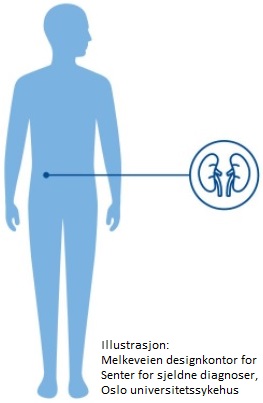 Blæreekstrofi/epispadi - NHI.no